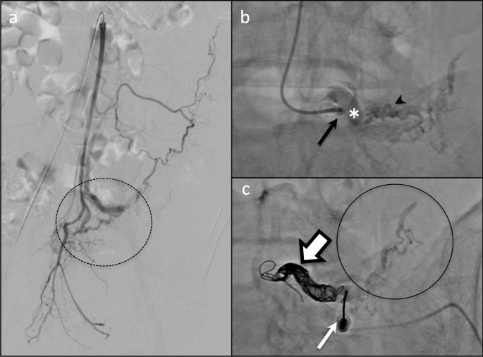 Successful Treatment of Inferior Mesenteric Arteriovenous Malformation ...