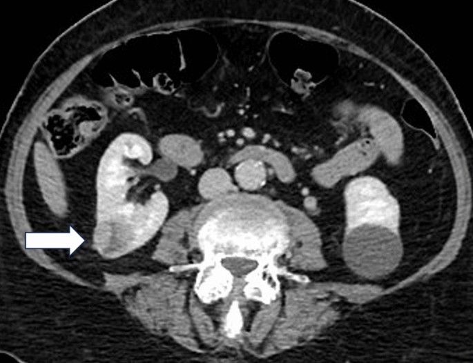 Early Clinical Histotripsy Treatment of Renal Cell Carcinoma ...