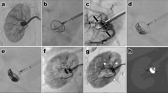 Intrasaccular Embolization of a Wide-Neck Bifurcation Aneurysm Using a ...
