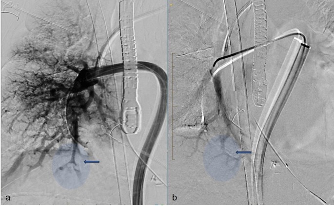 Percutaneous Vegetectomy for Fungal Tricuspid Valve Endocarditis: A ...