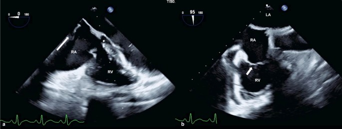 Percutaneous Vegetectomy for Fungal Tricuspid Valve Endocarditis: A ...