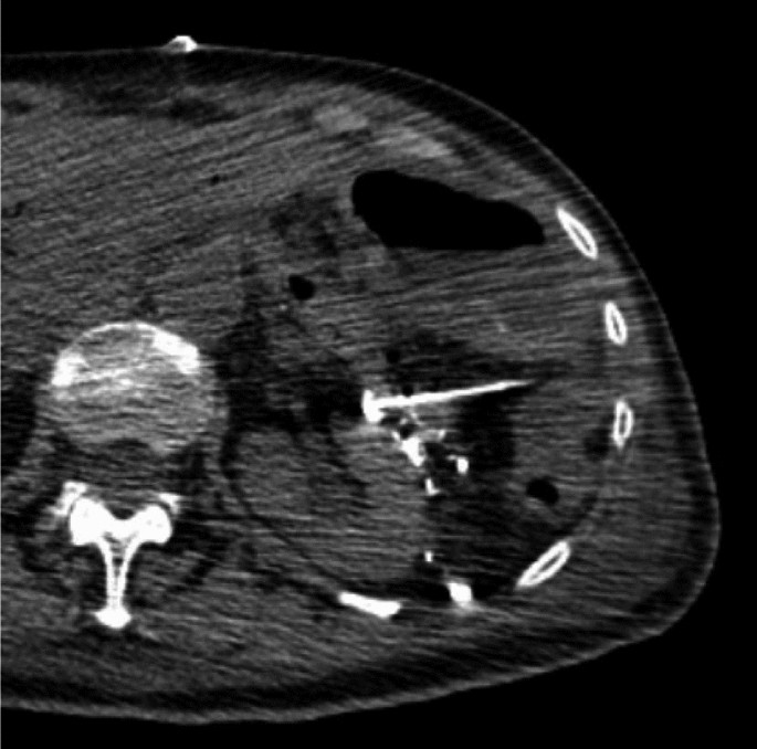 Ultrasound-Guided Percutaneous Mesenteric Lymphangiography and Ethanol ...
