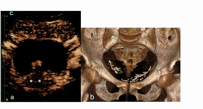 Commentary on “Prostatic Artery Embolization Using Ethylene Vinyl ...