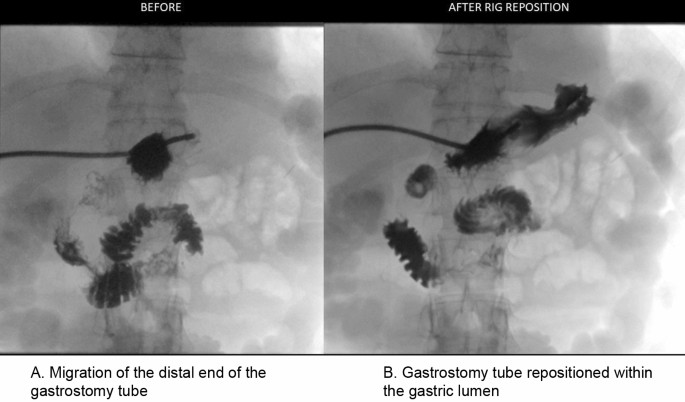 Dumping Syndrome: An Uncommon Complication of Percutaneous Gastrostomy ...