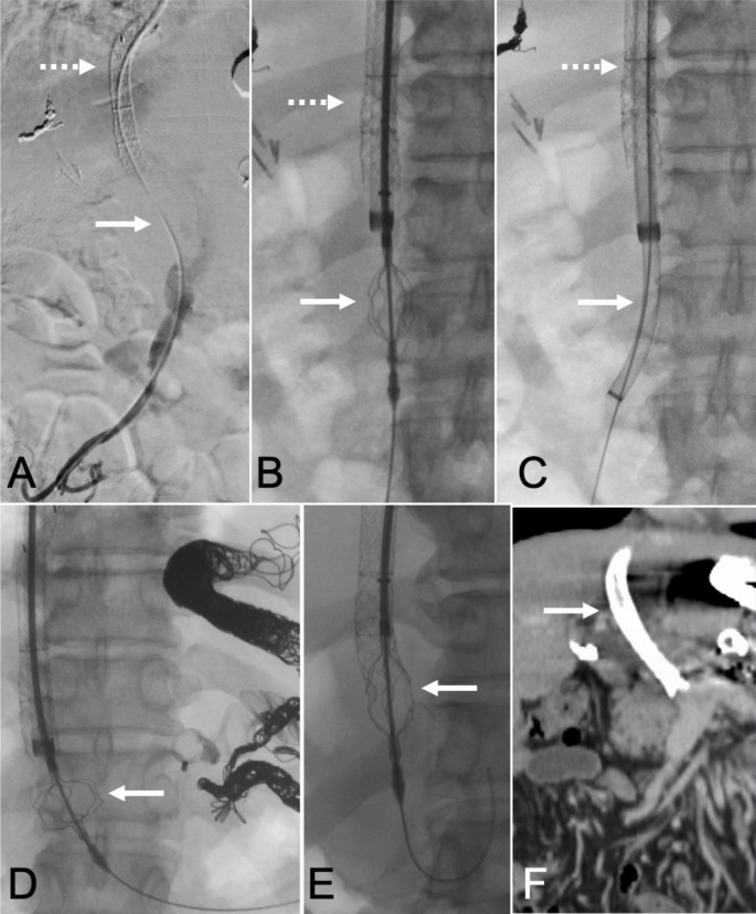 Portomesenteric Venous Mechanical Thrombectomy Using RevCore ...