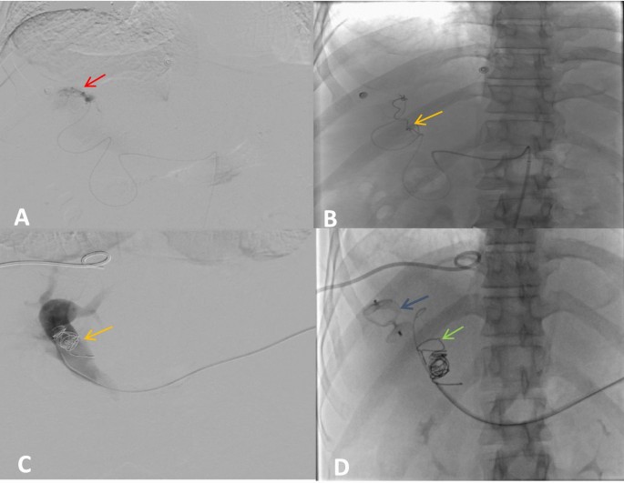 Complex Endovascular Management of a Large Traumatic Intrahepatic ...