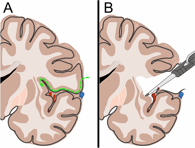 Frontal trans opercular approaches to the insula: building the mental ...