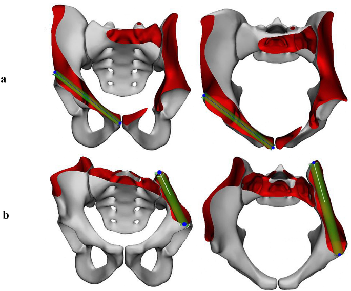 Evaluation of the superior pubic ramus and supra acetabular corridors ...