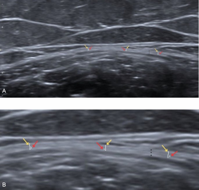 Sonographic measurement of deep fascia parameters – Interrater ...