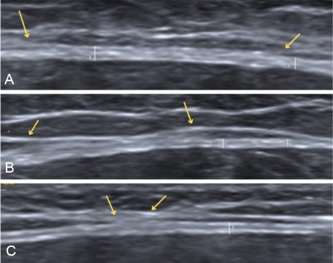 Sonographic measurement of deep fascia parameters – Interrater ...