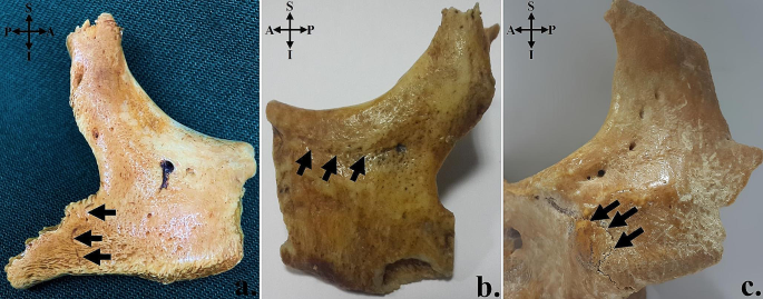 Assessing the frequency and variability of accessory zygomatic sutures ...