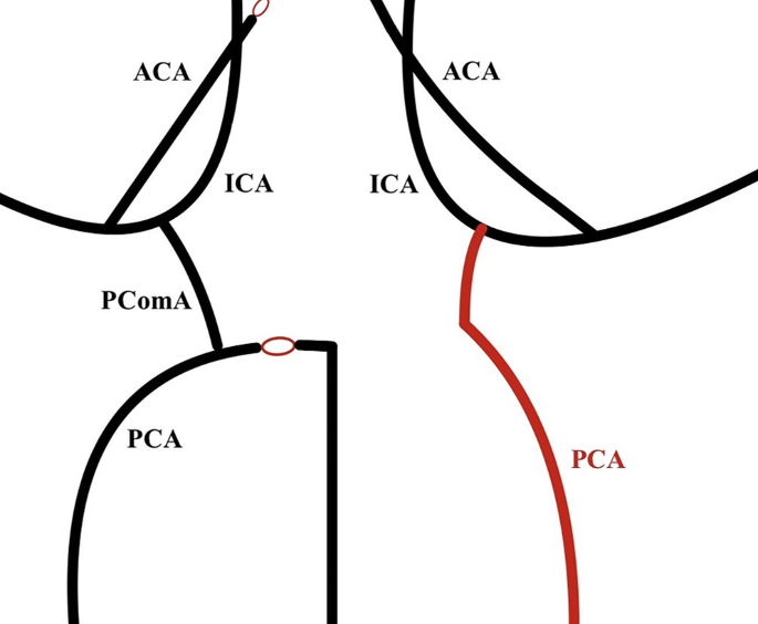 Fenestration of the anterior and posterior cerebral arteries in ...
