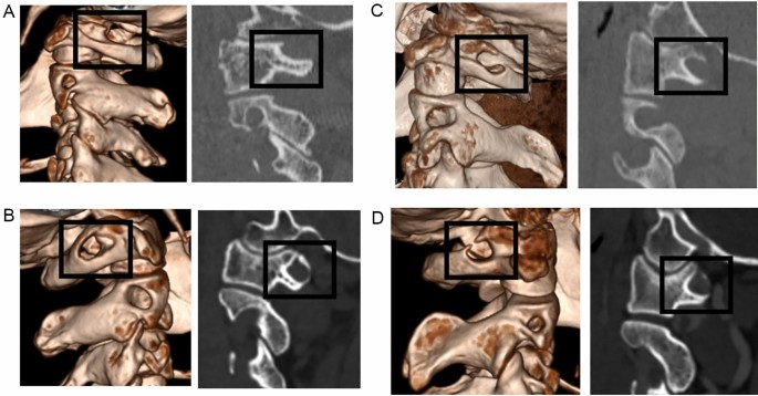 Does ponticulus posticus affect vertebral artery diameter | Surgical ...