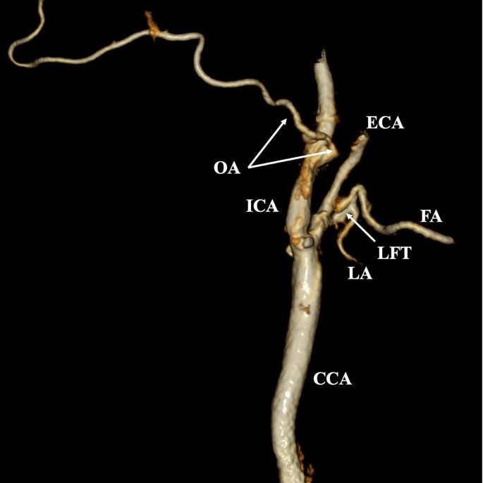A scarce combination of arterial variants: an occipital artery ...
