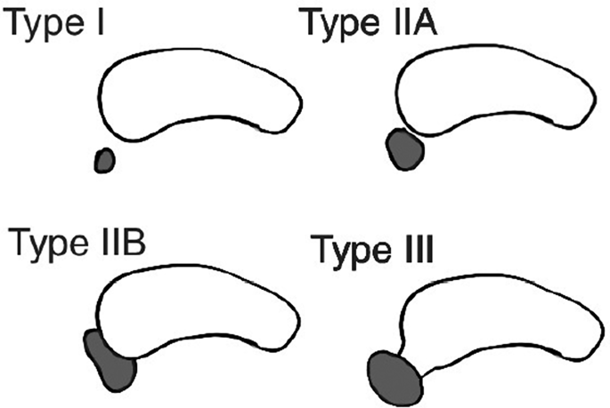 The prevalence and anatomy of accessory navicular bone: a meta-analysis ...