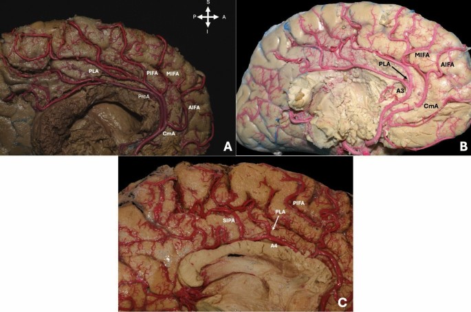 The microsurgical anatomy of the paracentral lobule artery: a cadaveric ...