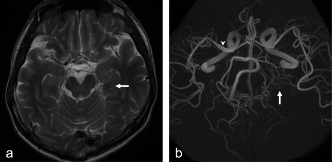 Accessory posterior cerebral artery as a duplicate anterior choroidal ...