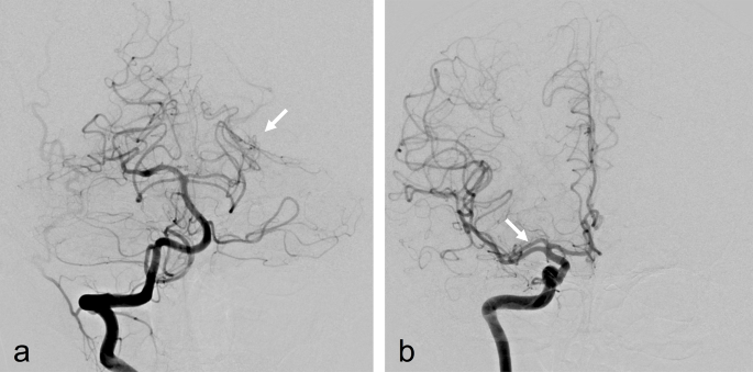 Accessory posterior cerebral artery as a duplicate anterior choroidal ...