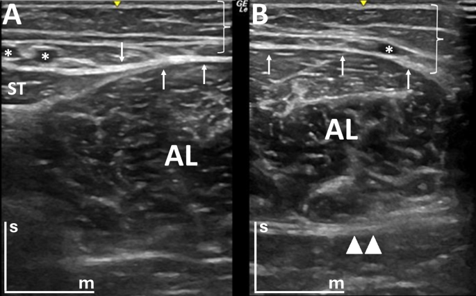 Are palpation-guided interventional procedures on the adductor longus ...