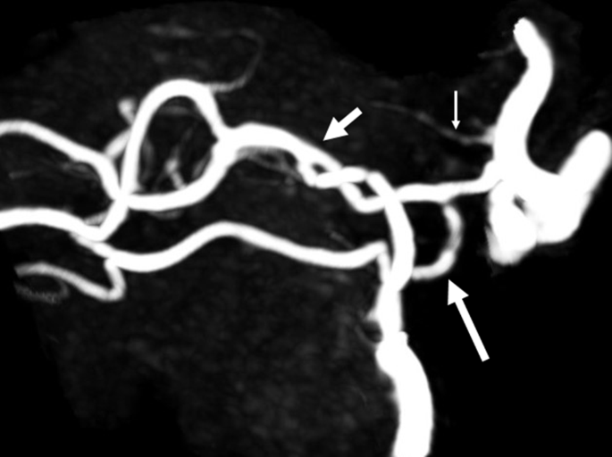 Abnormal fusion between the long P1 segment of the posterior cerebral ...