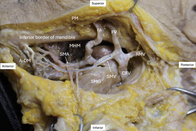 Clinical anatomy of the submental vein | Surgical and Radiologic Anatomy