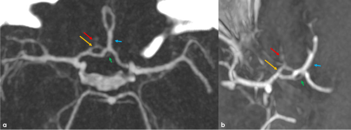 Dual fenestration of the A1 and azygos A2 segments of the anterior ...