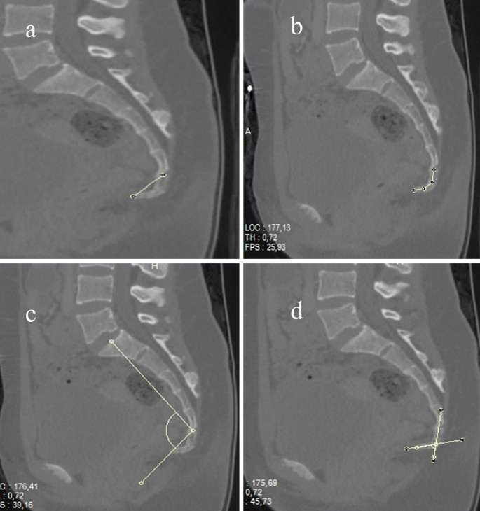 Morphologic evaluation of the coccyx in the pediatric population ...