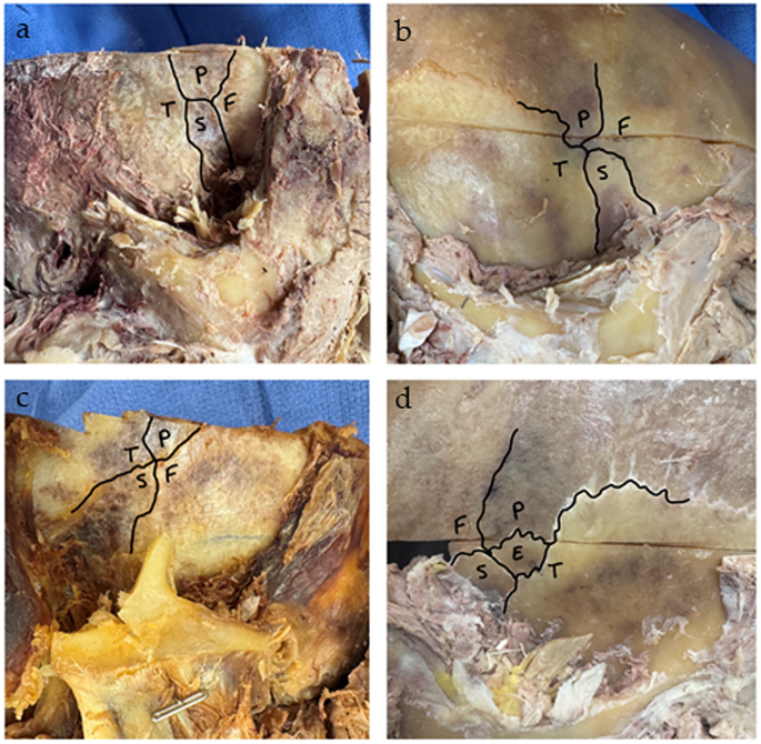 Surgical anatomy of the pterion and its relationship to the middle ...