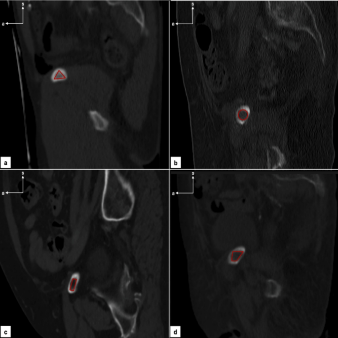Iliopubic rami morphology and its vascular relationships in ...