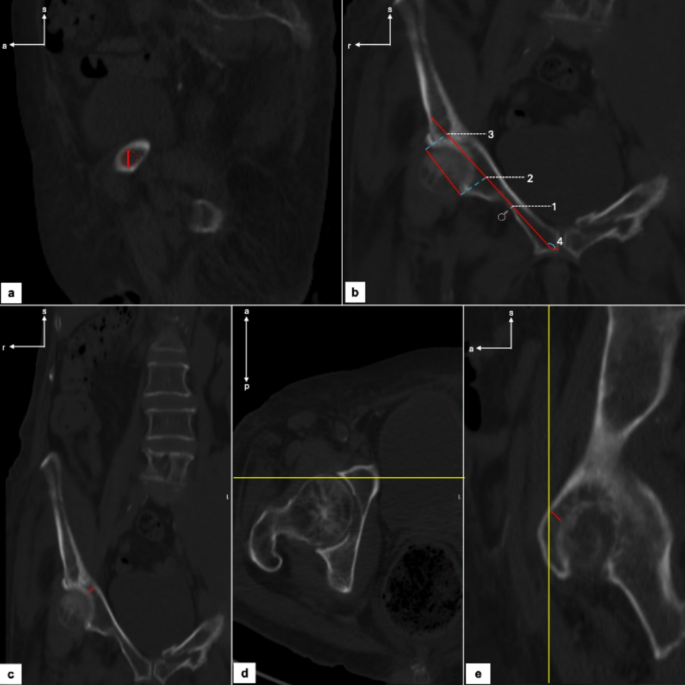 Iliopubic rami morphology and its vascular relationships in ...