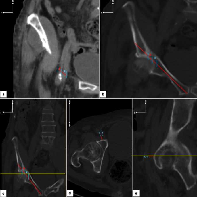 Iliopubic rami morphology and its vascular relationships in ...