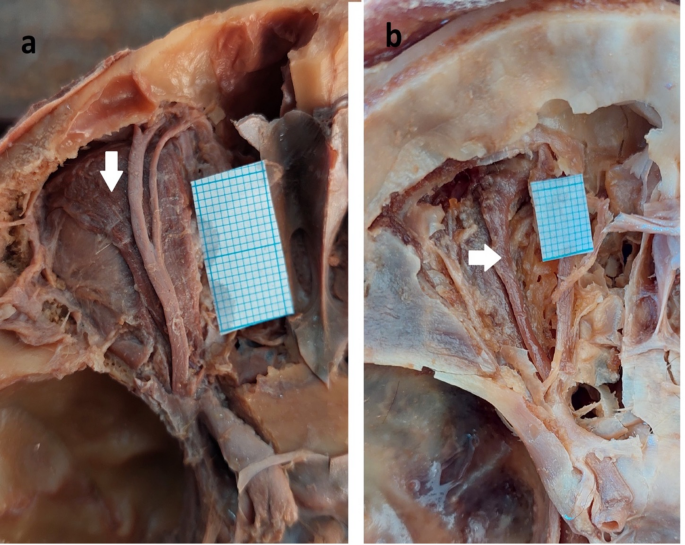Anatomical investigation of levator palpebrae superioris muscle and the ...