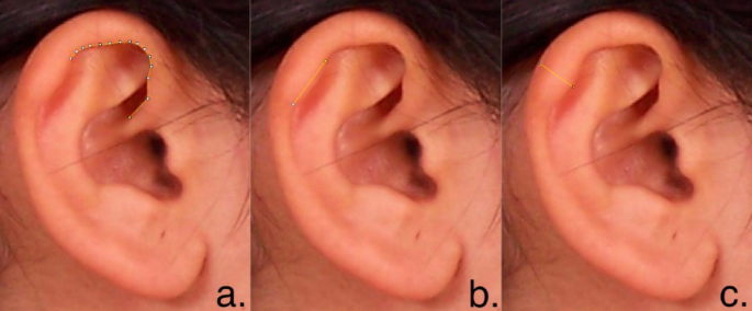 Evaluation of tuberculum auriculare (Darwin’s Tubercle) in terms of ...