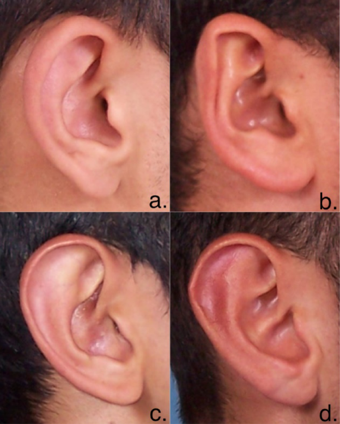 Evaluation of tuberculum auriculare (Darwin’s Tubercle) in terms of ...
