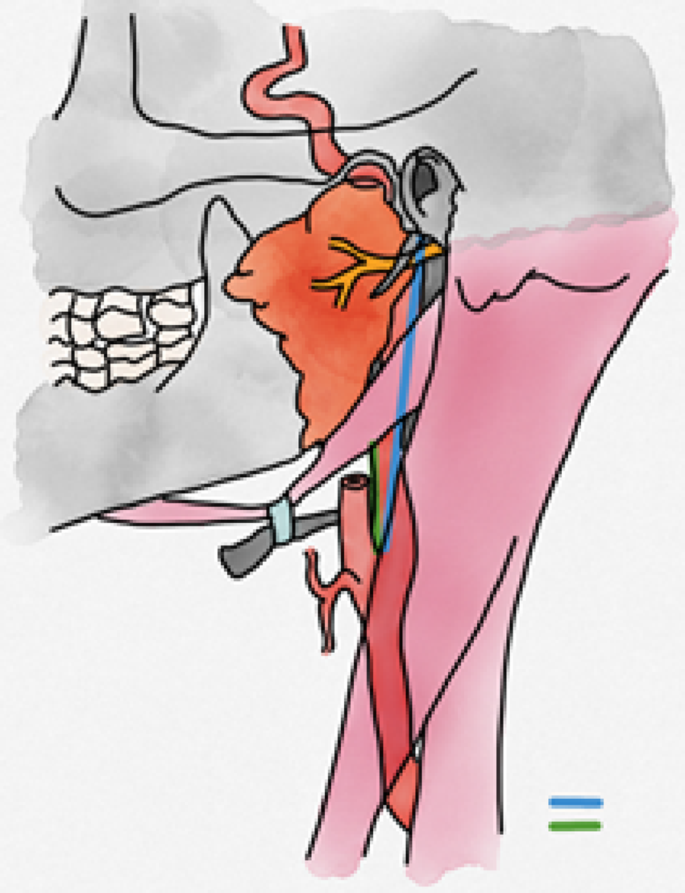 Anatomical and surgical insights into double mandibular osteotomy with ...