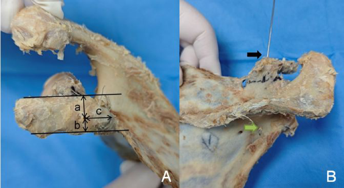 Morphometric analysis of the coracoid process in the Chinese population ...