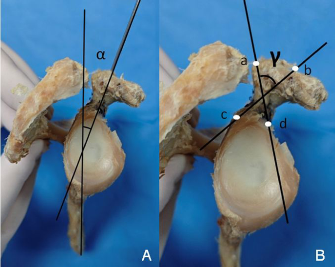 Morphometric analysis of the coracoid process in the Chinese population ...