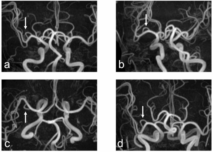Semicircular fenestration of the mid M1 segment of the middle cerebral ...