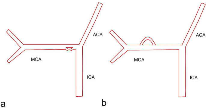 Semicircular fenestration of the mid M1 segment of the middle cerebral ...