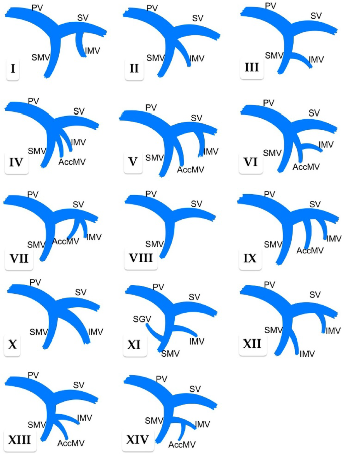 Portal vein confluence variants on contrast-enhanced CT: distribution ...