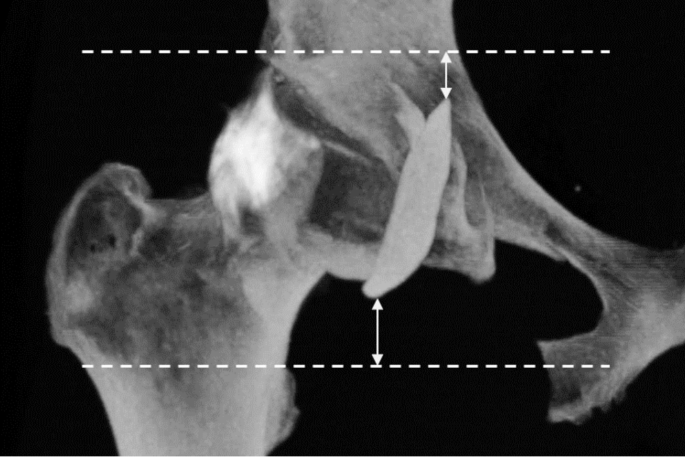 Iliopsoas bursa: a morphological study based on CT-arthrography ...