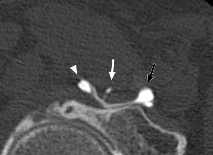 Iliopsoas bursa: a morphological study based on CT-arthrography ...