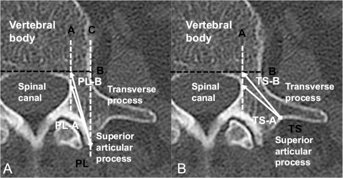 Distance to the spinal canal and vertebral body from the insertion ...