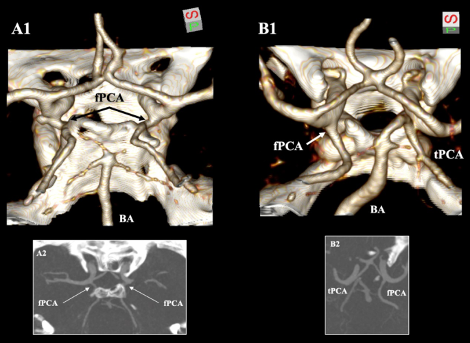 A novel classification of the basilar artery bifurcation height and the ...