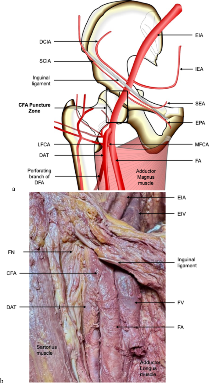 Arterial variation relevant to transfemoral transcatheter aortic valve ...