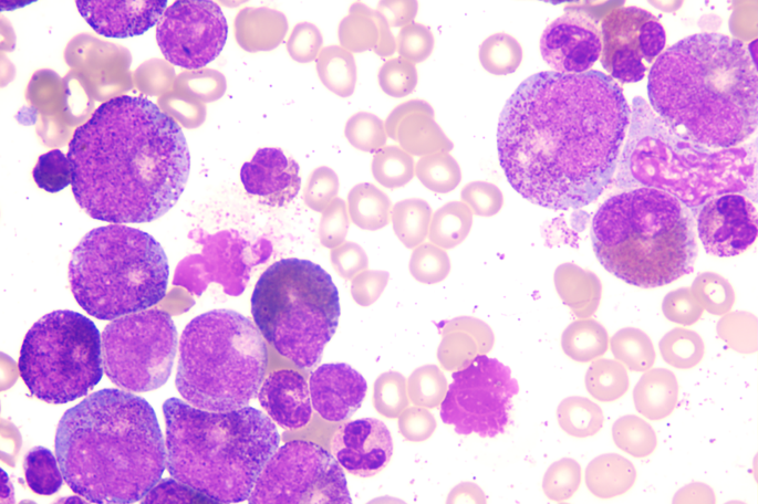 ETV6::ABL1 positive myeloid/lymphoid neoplasms with eosinophilia and ...