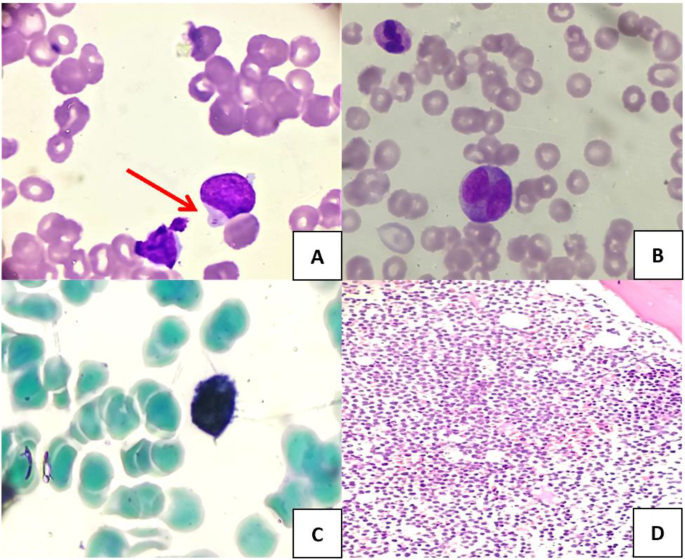 Ischemic stroke as a presenting feature of promyelocytic blast phase in ...