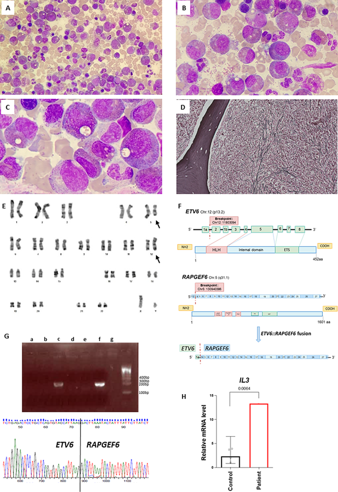 Novel ETV6::RAPGEF6 fusion gene in chronic eosinophilic leukemia ...