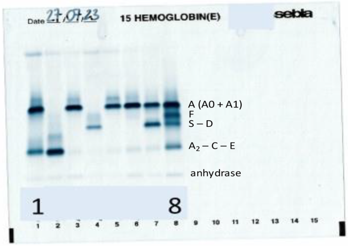 Combined heterozygosity for hemoglobin Paksé, α-thalassemia and for ...