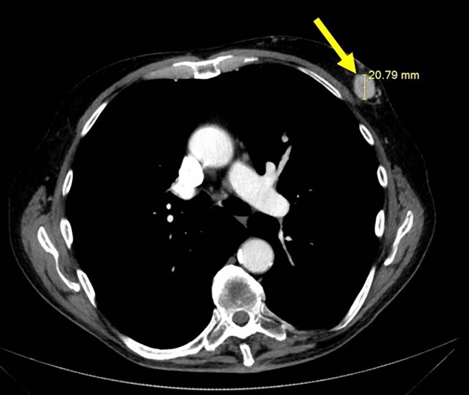 Ein Knoten in der männlichen Brust – Fallbericht einer ungewöhnlichen ...